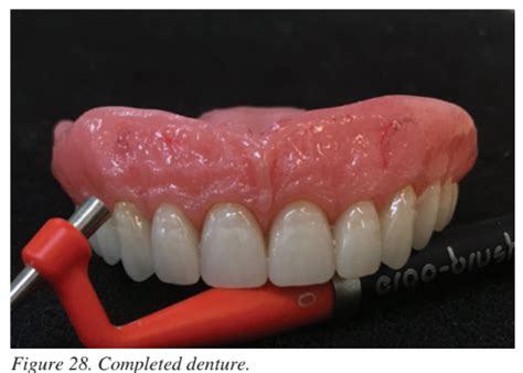 Metal Free Solutions For The Reinforcement And Repair Of Denture