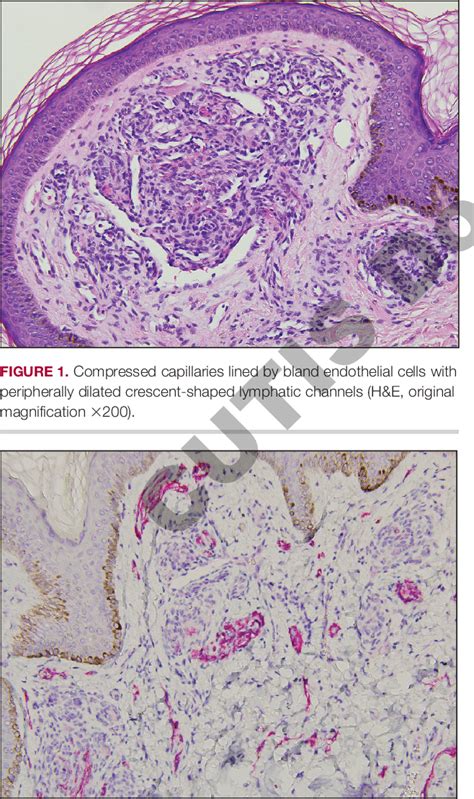 Figure 1 From Vascular Plaque In A Pregnant Patient With A History Of