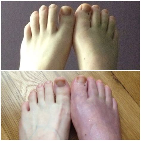 Why Do My Toes Turn Purple When I Stand At Isabelle Odonovan Blog
