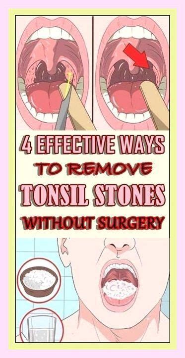 Remove Tonsil Stones Artofit