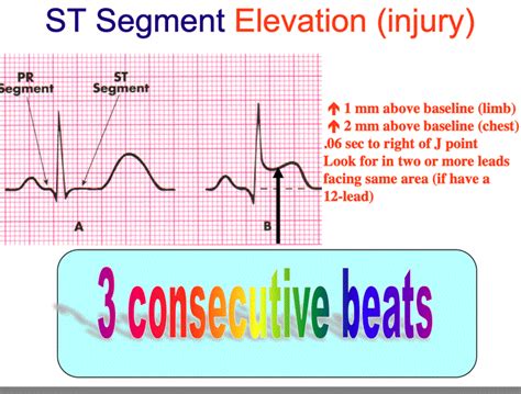 St Elevation