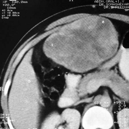 Post Operative Specimen Showing Bosselated Appearance With Intact