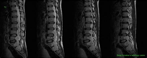 Dr Balaji Anvekars Neuroradiology Cases Plexiform Neurofibroma Spine