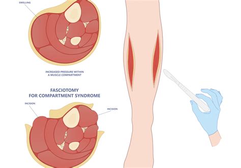 Icam Extensor Tendon Protocol Zone 4 7