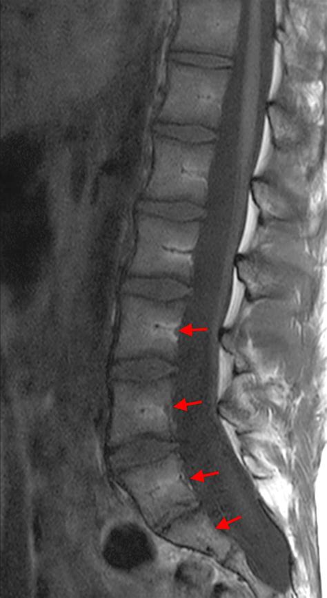 Thecal Sac Mri