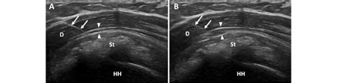 Subacromial Bursa Injection Findings Long Axis View Of The