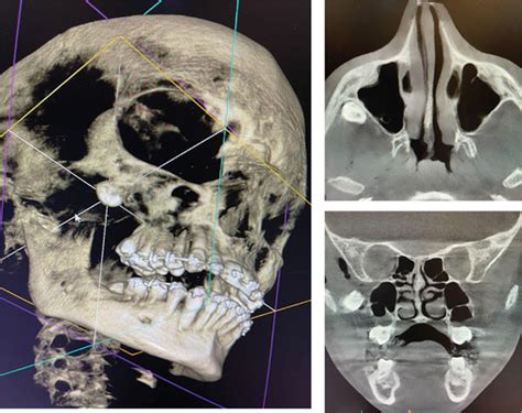Maxillary Third Molar Anatomy Full Article Ce Credit Maxillary
