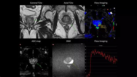 Mri And Mrius Biopsy For Prostate Cancer Philips