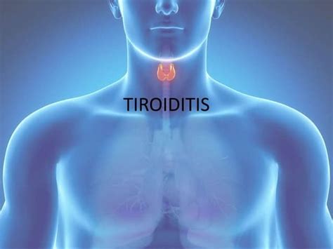 Tiroiditis Ppt