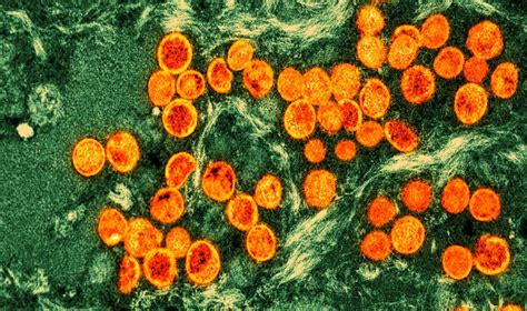 Whos New Mpox Guidance All Contacts Should Avoid Sex For 21 Days Cidrap