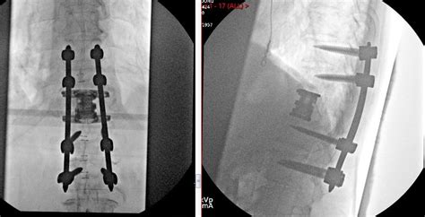 Thoracic Corpectomy Joshua Li Md Phd