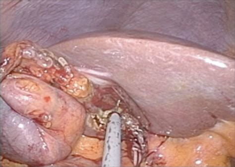 Dissection Of The Gallbladder Off The Liver Bed Using Suction Hook