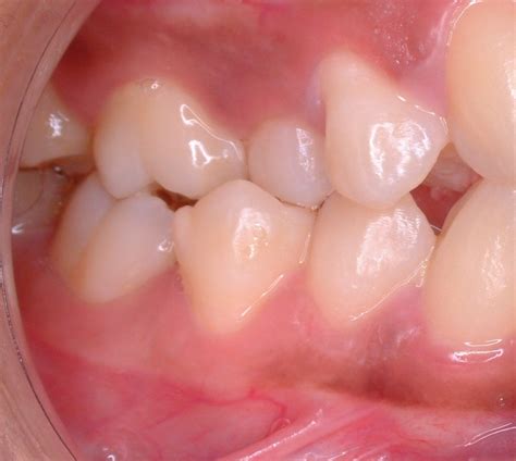 Malocclusion Part Ii Causes Of Malocclusion Singapore Orthodontics