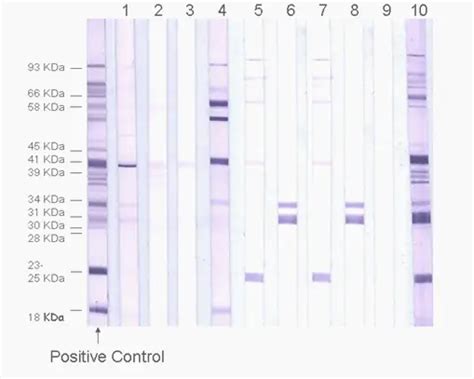 Igenex Tick Borne Disease Testing Methodologies