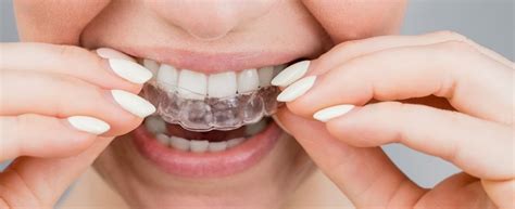 Orthodontic Retainers Types Cost Pros And Cons Care OFF