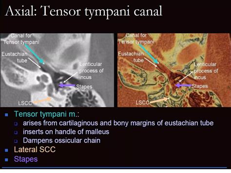 Temporal Bone Radiology Pptx
