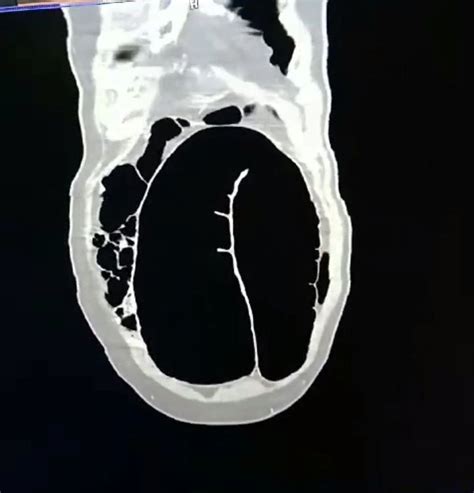 Dr Arunkumar N R On Linkedin Compound Volvulus Ileo Sigmoid Knotting