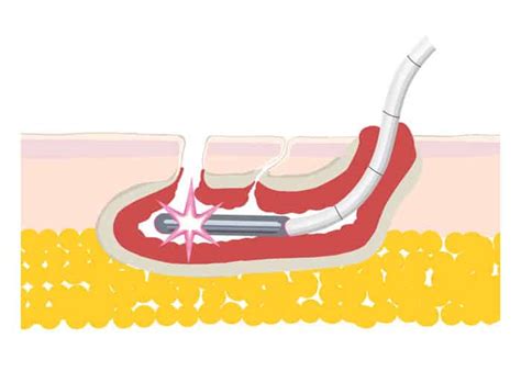Pit Picking Operationstechnik Pilonidal Sinus Zentrum München