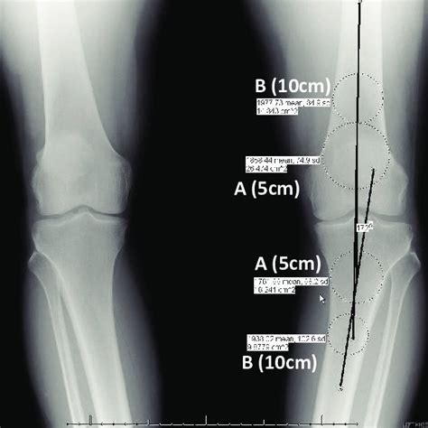 Miniaci Method For Frontal Plane Correction Aline 1 Represents The Download Scientific