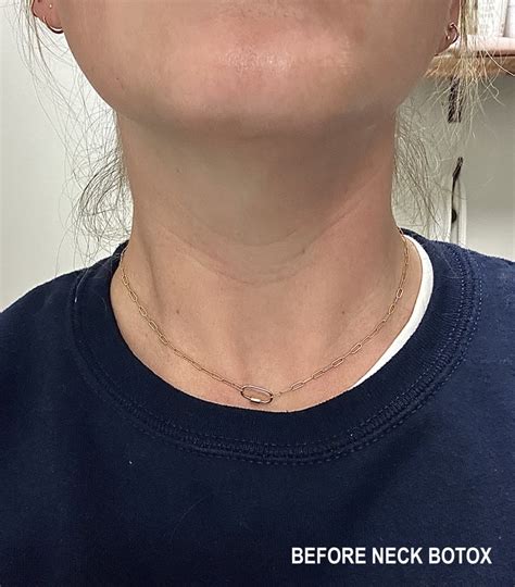 I Got Neck Botox See Before And After Photos Ps Beauty