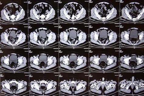 Tomografia Computorizada O Que é E Como é Feita