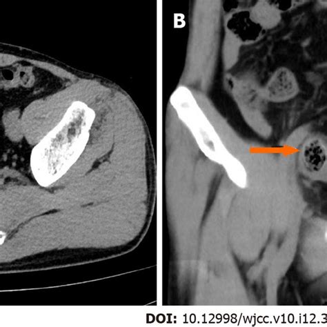 Computed Tomography Revealed A Circinate High Density Image With Short