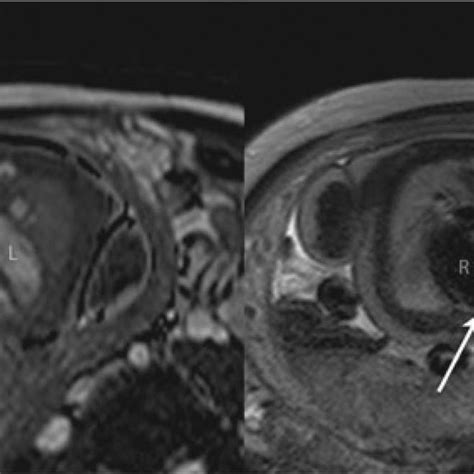 Comparison Of Cine Mri Methods Applied To The Human Fetal Heart Download Scientific Diagram