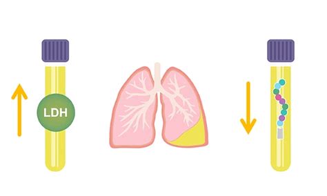Differentiating Transudative And Exudative Pleural Effusions Medmastery