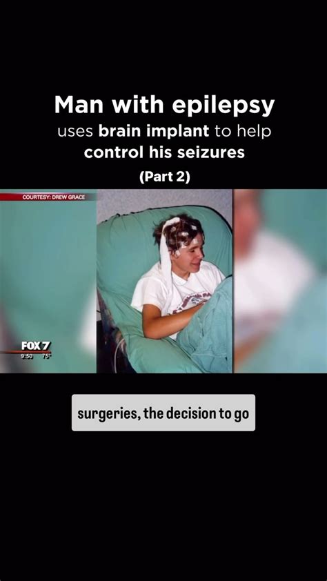 Epilepsy Brain Implants For Seizures