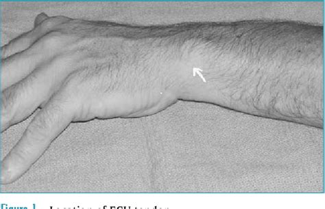 Figure 1 From Extensor Retinaculum Tear In An Amateur Golfer Semantic