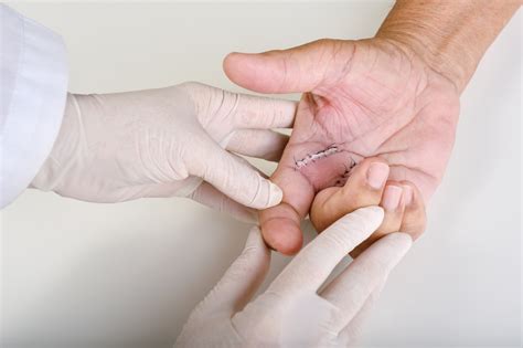 Hand And Microsurgery Klinik Orthopedik Dr Shaffid