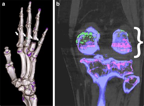 Dect Metal Streak Beam Hardening And Photon Starvation Artifacts Download Scientific Diagram
