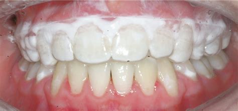 Patient E Wearing A Thermoplastic Retainer Filled With Recaldent Gc