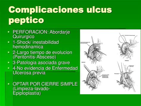 Ppt Complicaciones Ulcus Peptico Powerpoint Presentation Free