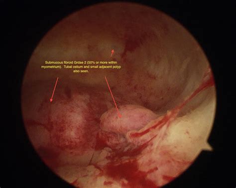 Diagnostic Hysteroscopy And Curettage Melbourne Fertility And Endosurgery Centre