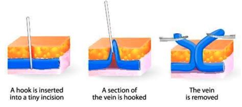 Microphlebectomy Cvt