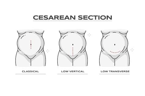 Caesarean Section Vectors And Illustrations For Free Download Freepik