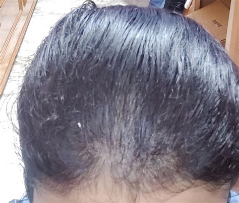 I Am Front Balding Dont Know What To Do R Telogeneffluvium