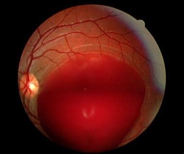Valsalva Retinopathy Background Etiology Pathophysiology