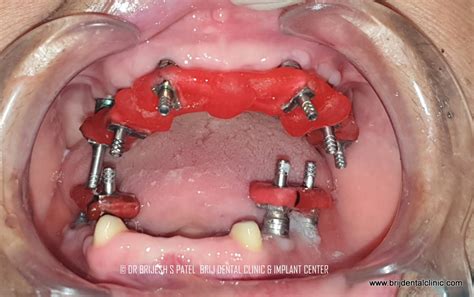 Full Mouth Dental Implants Cost In Ahmedabad India