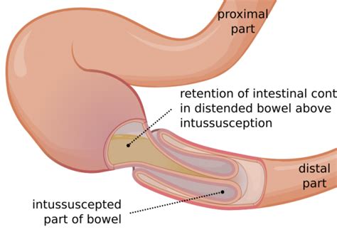 Intussusception Wikem