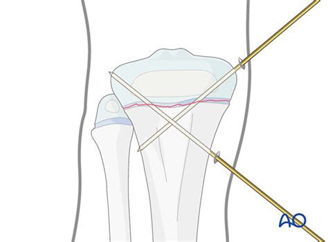 Closed Reduction K Wire Fixation For Epiphysiolysis Salter Harris I