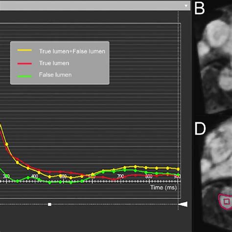 Quantitative Flow Evaluation Of True Lumen And False Lumen Using Download Scientific Diagram