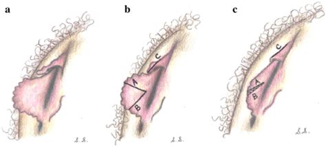 A Class 3 Wherein The Labia Minora Extend Well Beyond The Labia