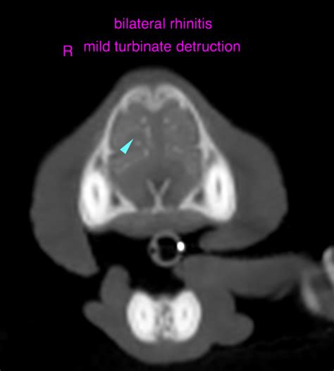 Ct Bilateral Non Destructive Rhinitis And Sinusitis Causing Upper