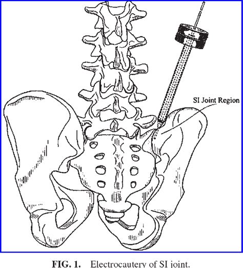 Sacroiliac Joint Injection Technique
