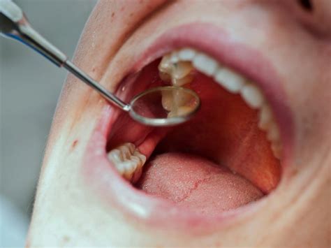 Hypoplasia Where It Can Occur Causes Effects And Treatment Options