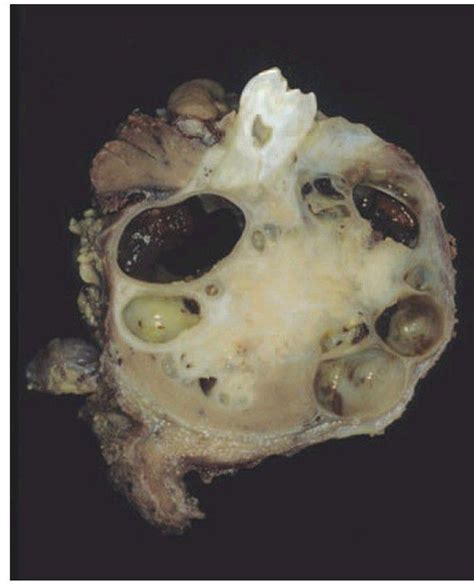 Ameloblastoma Medizzy