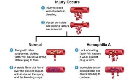 Factor Viii Fviii Deficiency Facebook