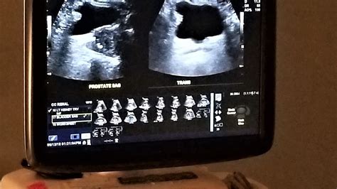 What Does An Ectatic Abdominal Aorta Mean On Ultrasound And When Is 29